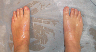 Feet - Hyperhidrosis UK